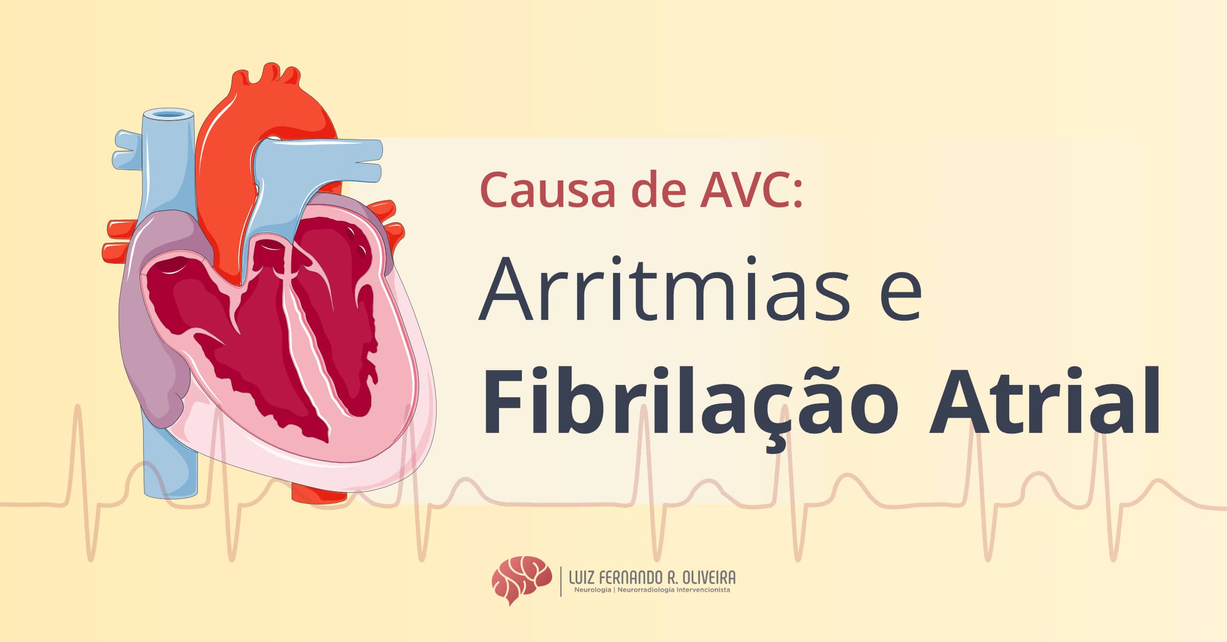 Causa De Avc Arritmias E Fibrilação Atrial Dr Luiz Fernando